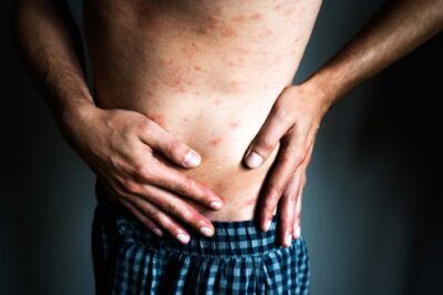 Waterpokken bij je baby - symptomen, behandeling en voorkomen